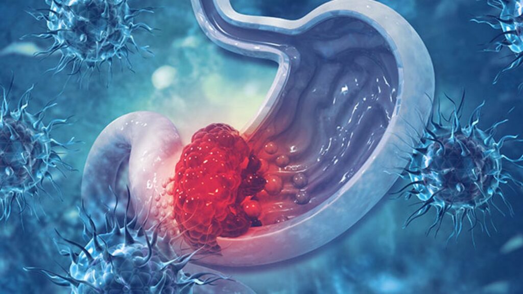 Stomach Operations and All to Know about it | Healing Consulting Turkey